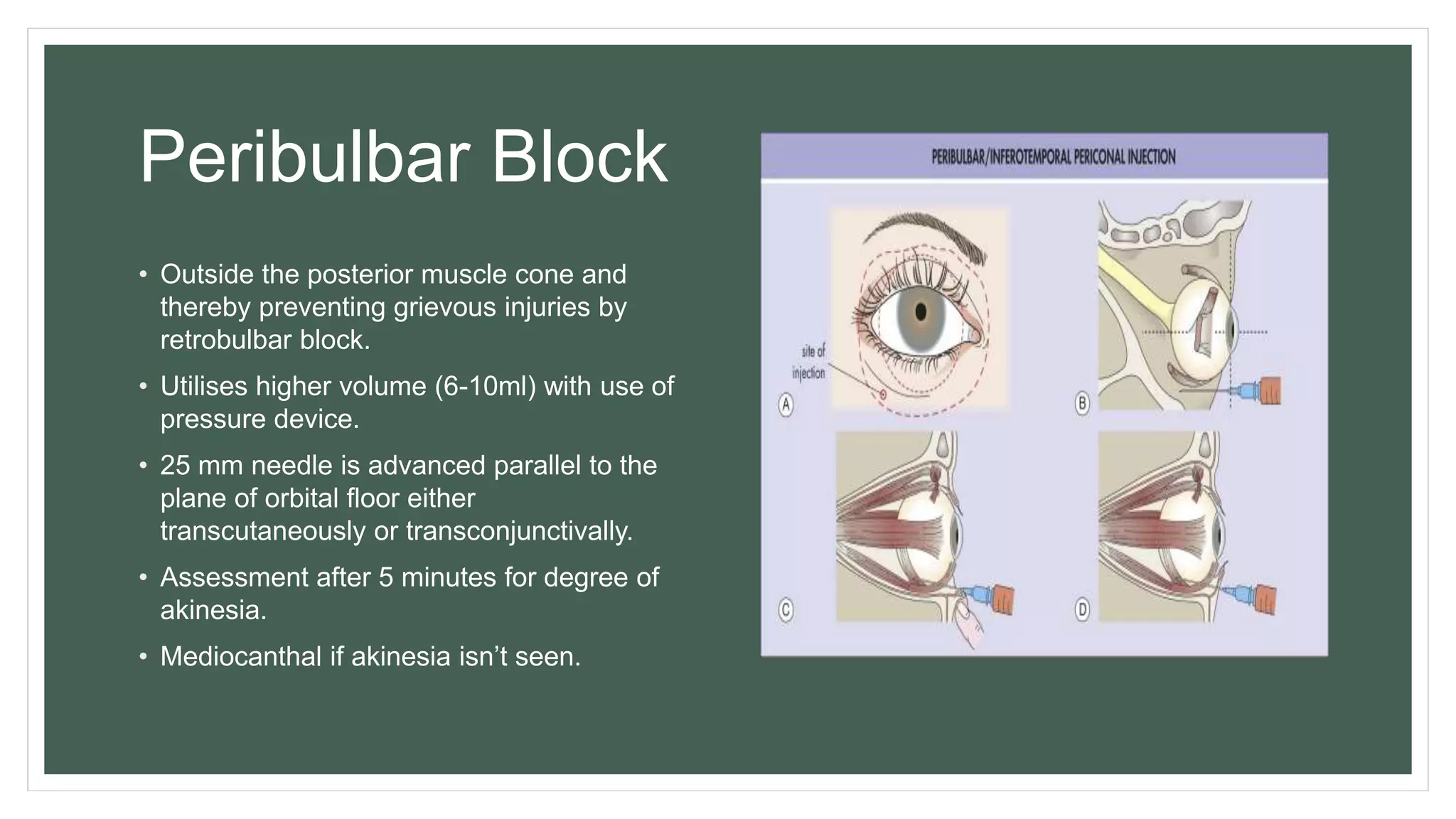 Anaesthesia for cataract surgery | PPTX