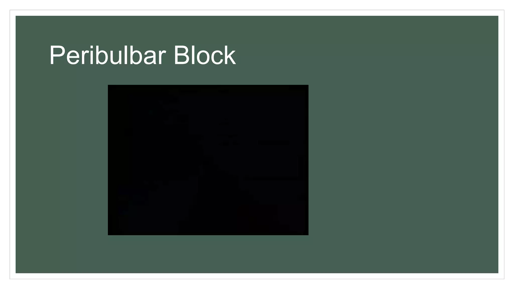 Anaesthesia for cataract surgery | PPTX