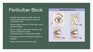 Anaesthesia for cataract surgery | PPTX
