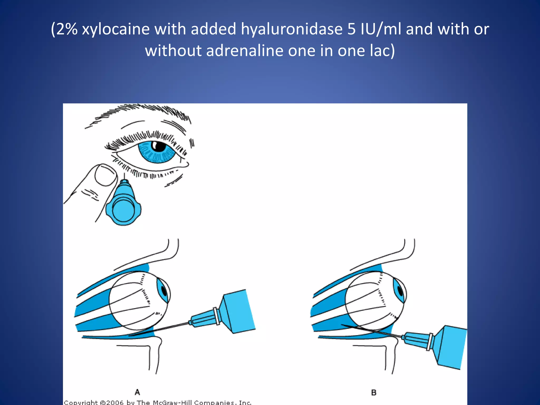 Anaesthesia for cataract surgery | PPTX