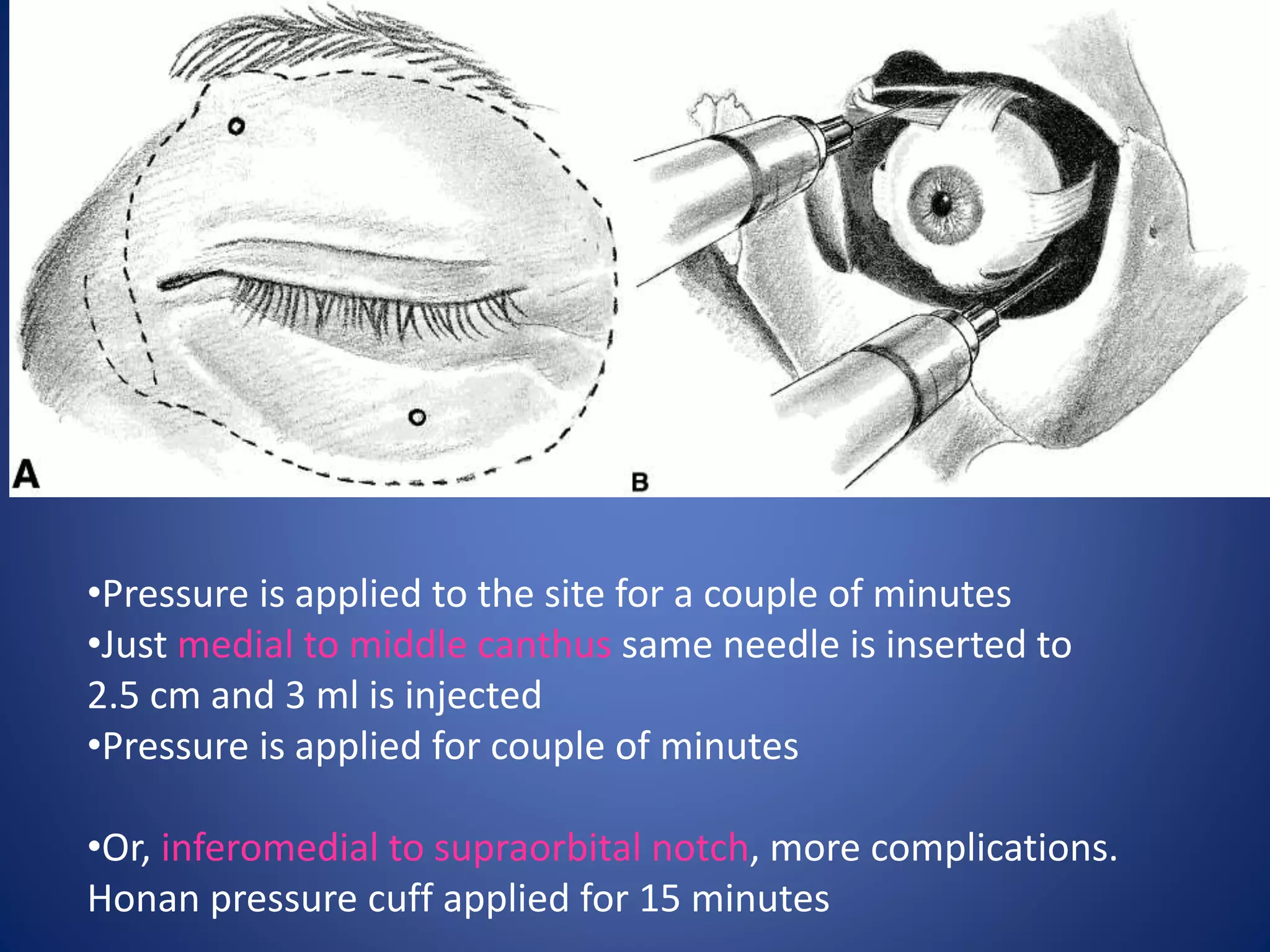 Anaesthesia for cataract surgery | PPTX