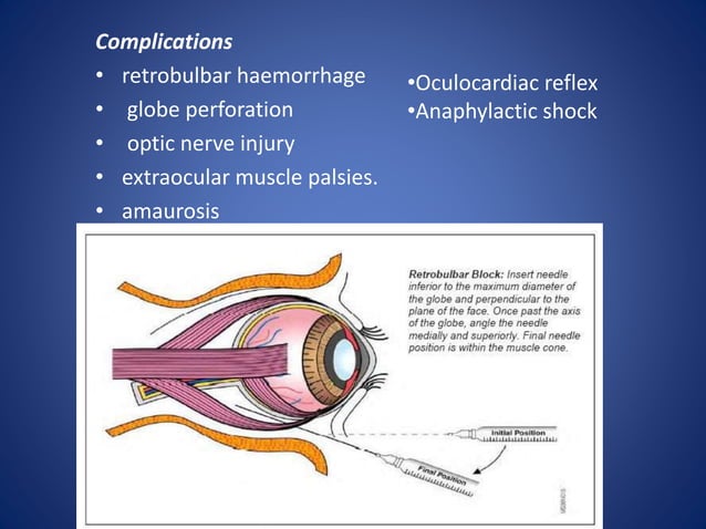 Anaesthesia for cataract surgery | PPTX