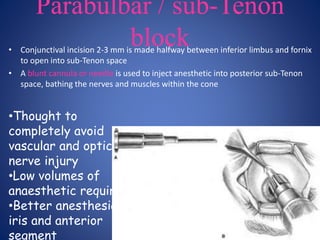 Anaesthesia for cataract surgery | PPTX