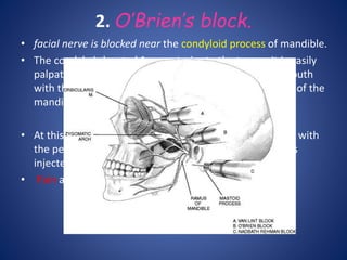Anaesthesia for cataract surgery | PPTX