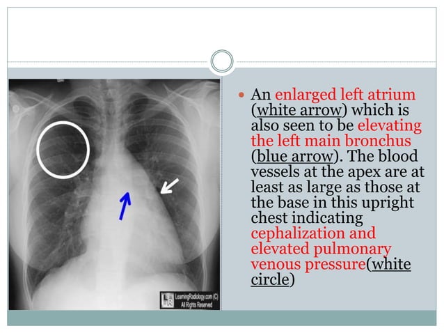 Anaesthesia for closed mitral valvotomy | PPTX | Heart and ...