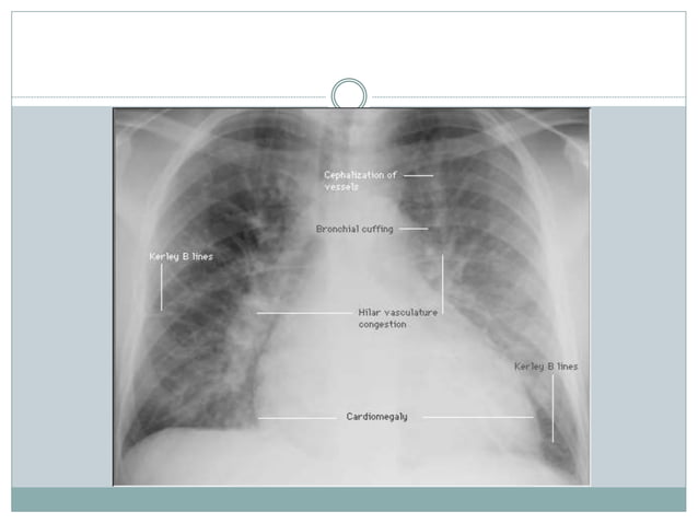 Anaesthesia for closed mitral valvotomy | PPTX | Heart and ...