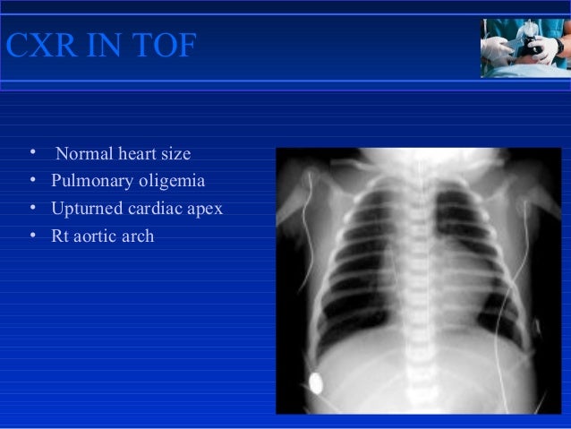 Anaesthesia for congenital heart disease