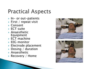 Anaesthesia for ELECTROCONVULSIVE THERAPY/ECT | PPT