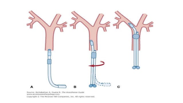 Anaesthesia for lung reduction surgery | PPTX