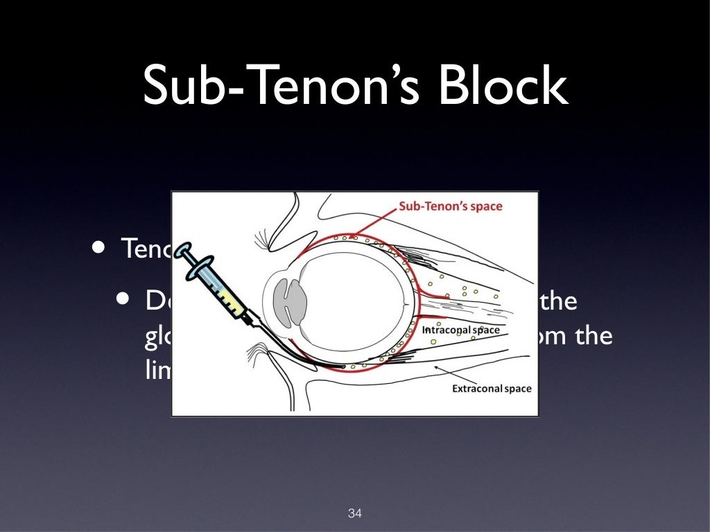 Anaesthesia for ophthalmic surgery