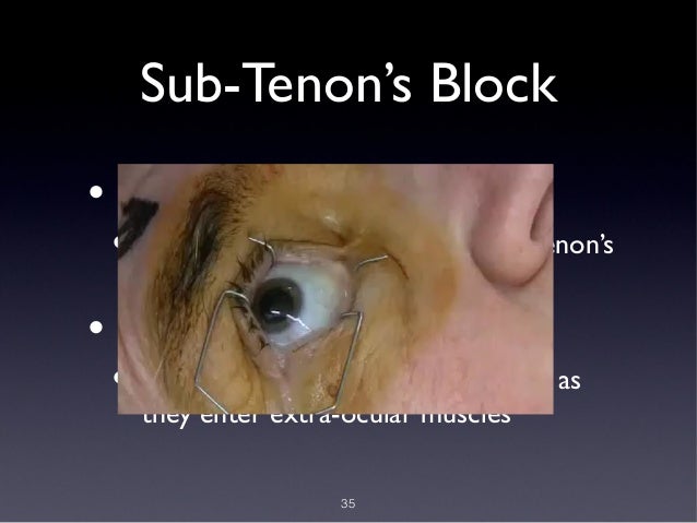 Anaesthesia for ophthalmic surgery