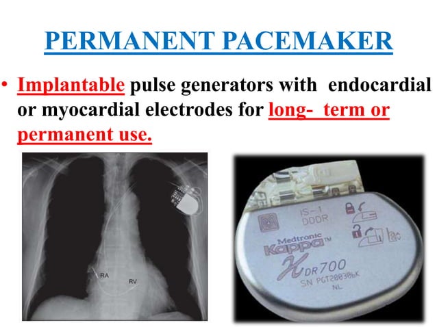 Anaesthesia for patient with pacemaker | PPT