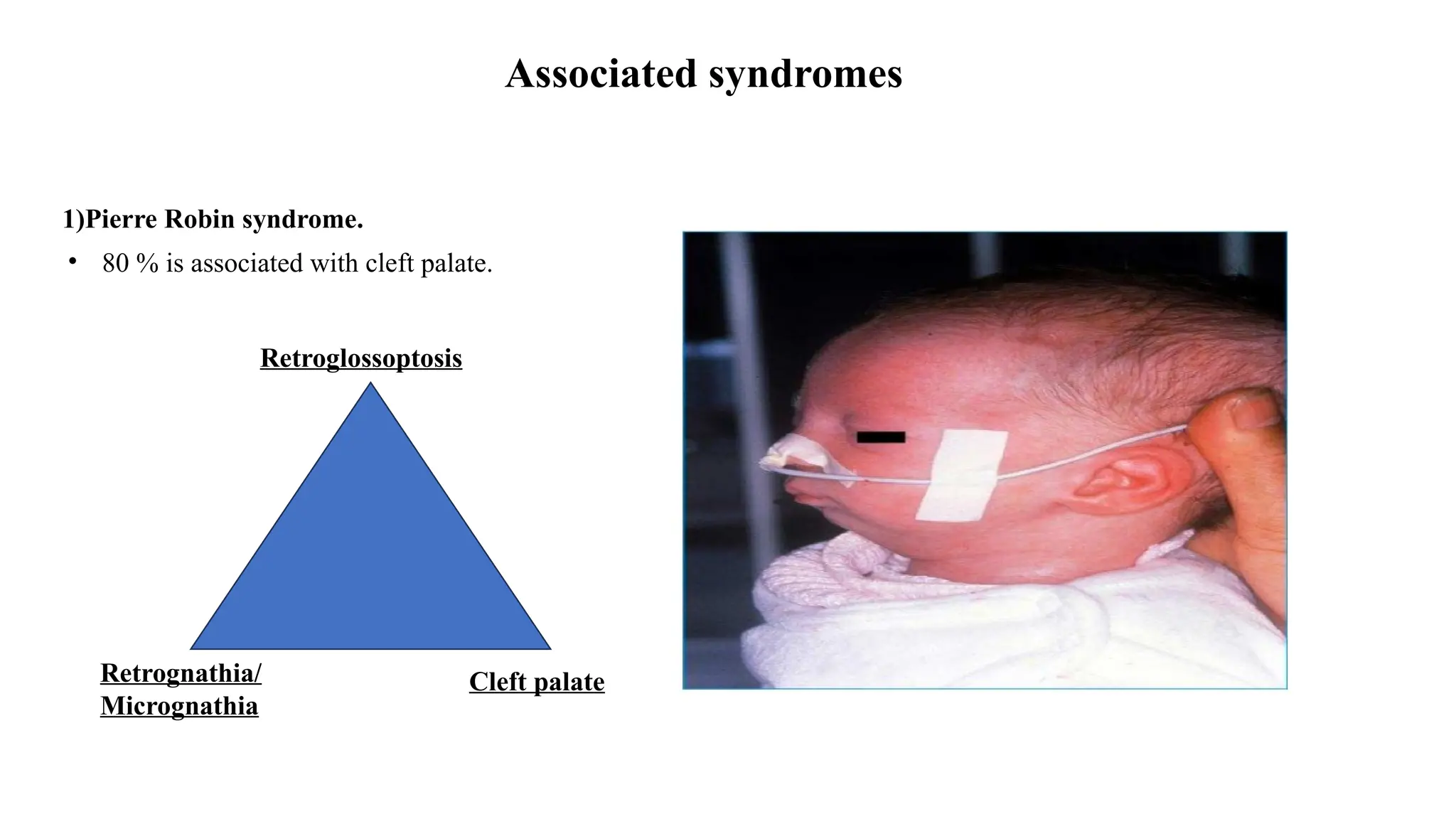 Anaesthesia in cleft and cleft palate surgeries ppt (1) (1).pptx