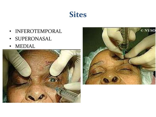 Anaesthesia in ophthalmic surgery | PPT | Eye and Vision Conditions ...