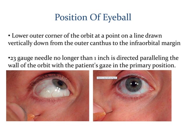 Anaesthesia in ophthalmic surgery | PPT | Eye and Vision Conditions ...