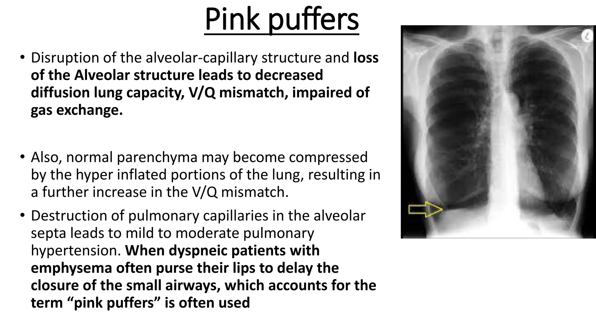 Anaesthesic Considerations in COPD.pptx