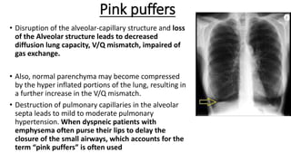 Anaesthesic Considerations in COPD.pptx