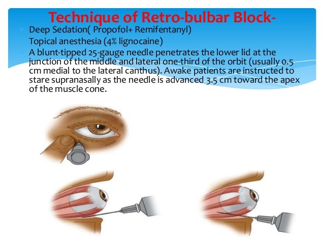Anaesthessia for EYE Surgery Ramprasad