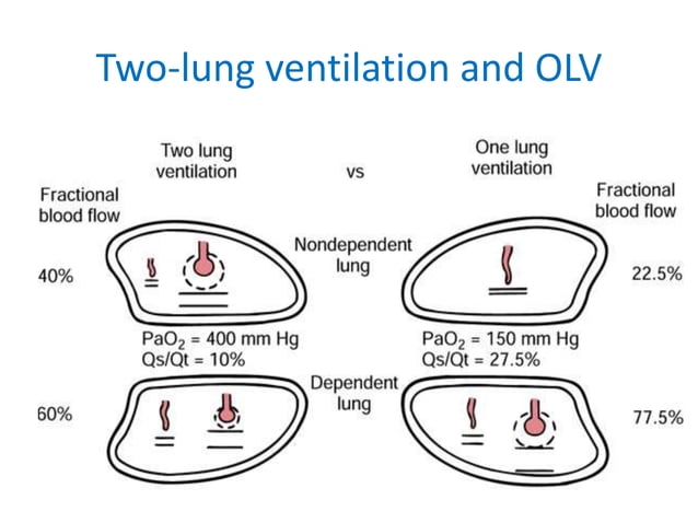 Anaesthetic consideration for one lung ventilation | PPTX