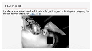 ANAESTHETIC CONSIDERATION IN MACROGLOSSIA DUE TO LYMPHANGIOMA OF TONGUE ...