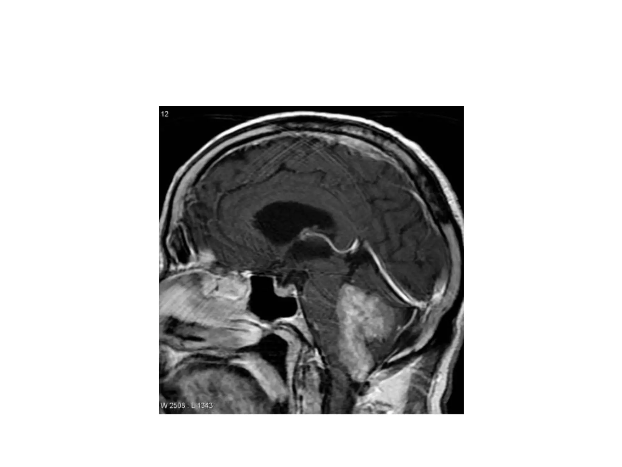 Anaesthetic considerations for posterior fossa surgery | PPTX