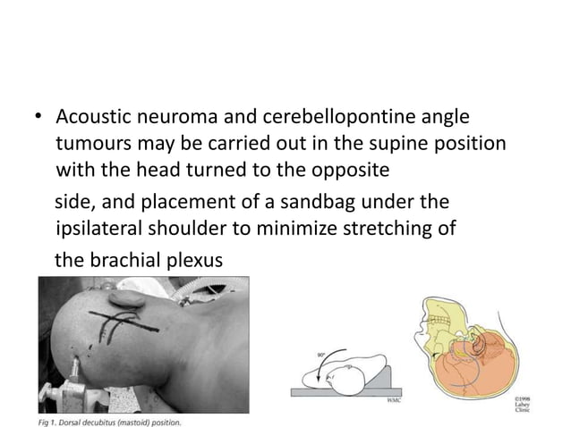 Anaesthetic considerations for posterior fossa surgery | PPTX