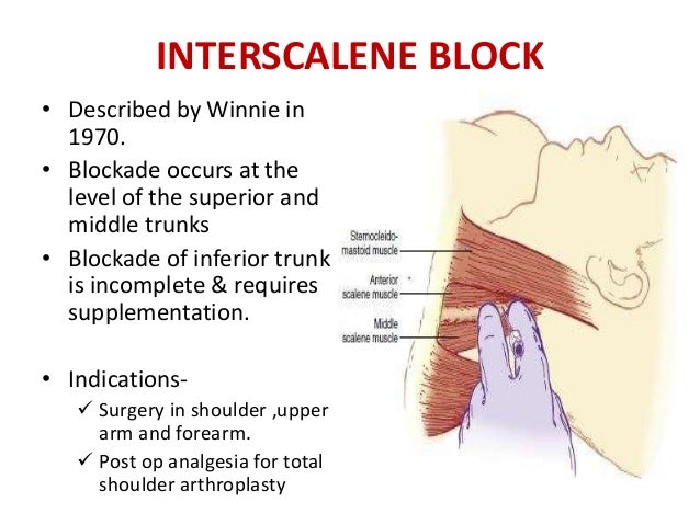 Interscalene Block Distribution