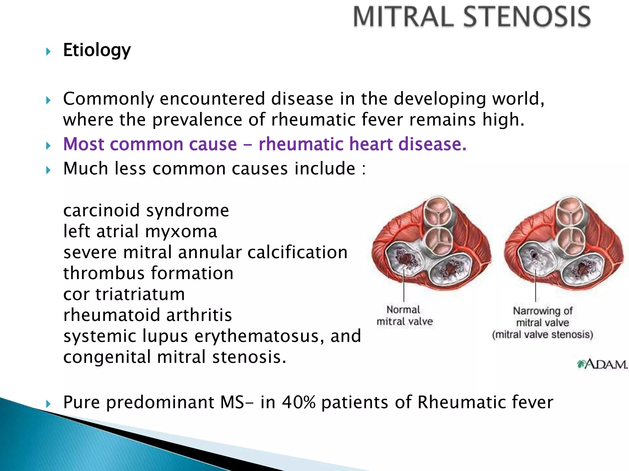 Anaesthetic management of mitral valvular heart disease | PPTX