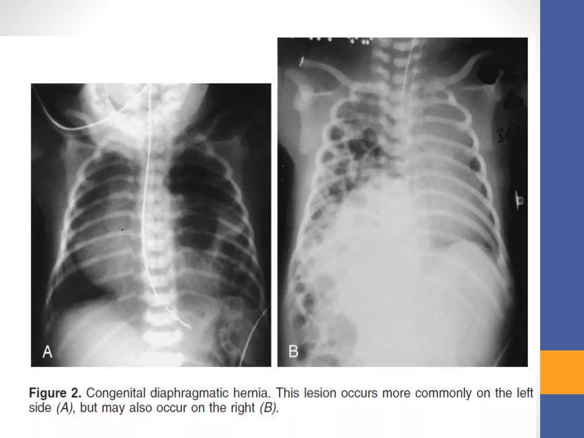 Anaesthetic management of tracheoesophageal fistula and congenital ...