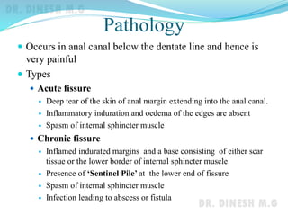Anal Fissure | PPTX