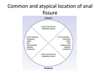 anal fissure.pptx........................... | PPTX