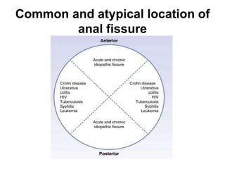 analfissure complete introduction, complications, treatment and ...