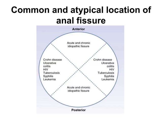 analfissure complete introduction, complications, treatment and ...