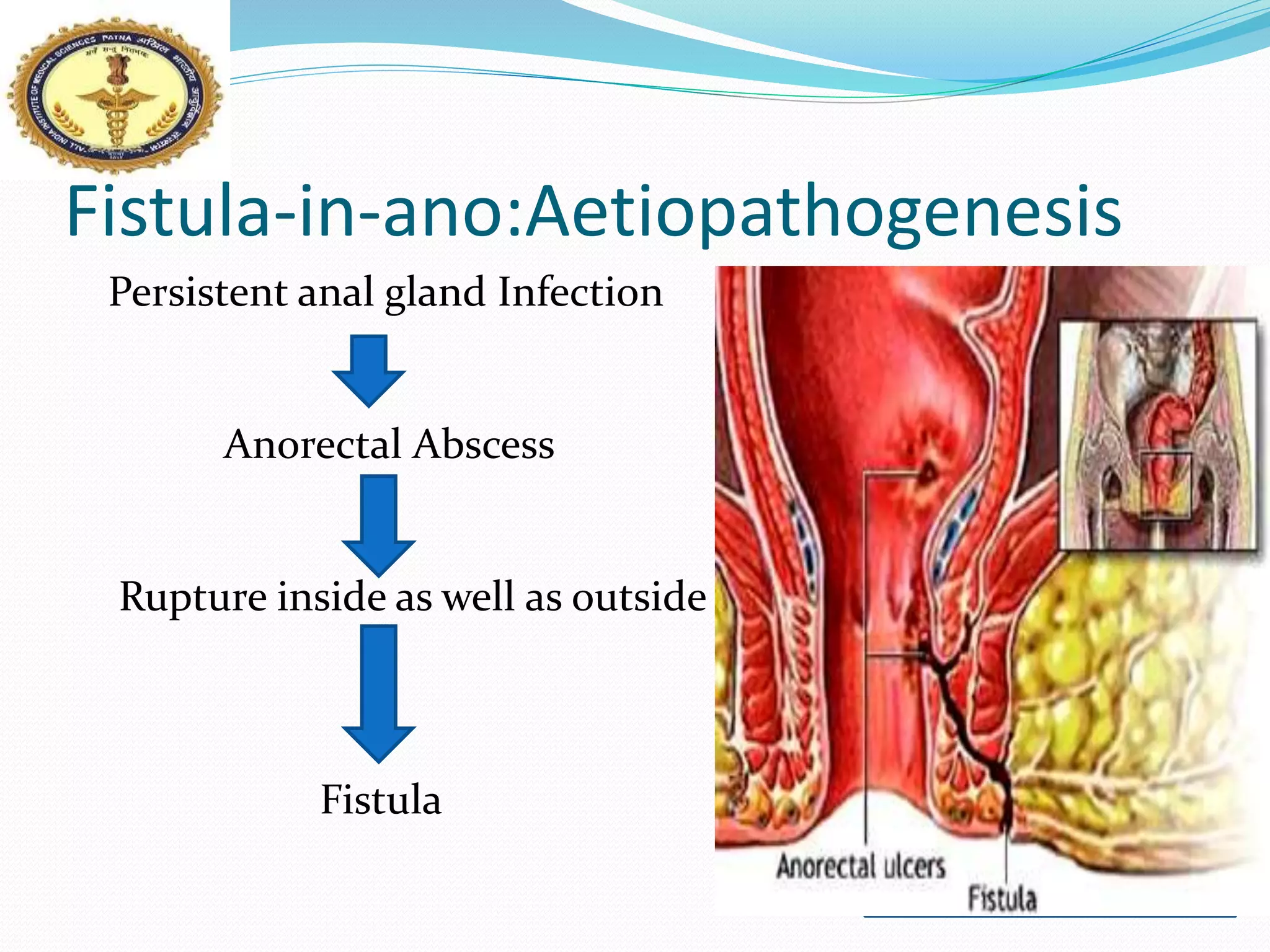 PPT by Dr Anil Kumar, Assitant Professor, AIIMS,Patna on Anal Fissure & Fistula in Ano | PPTX