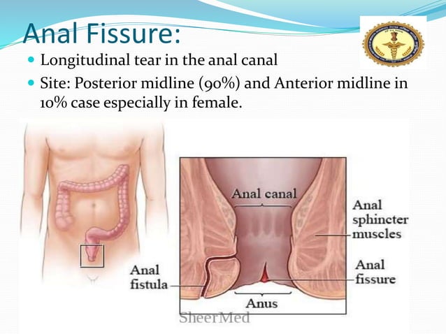 PPT by Dr Anil Kumar, Assitant Professor, AIIMS,Patna on Anal Fissure & Fistula in Ano | PPTX ...