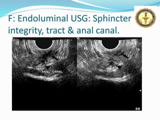 PPT by Dr Anil Kumar, Assitant Professor, AIIMS,Patna on Anal Fissure ...