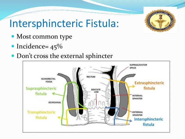 Fistula In Ano Types