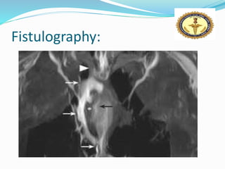 Anal fissure & fistula in ano PPT By Dr Anil Kumar, Assistant Professor ...