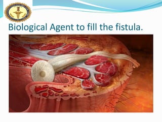 Anal fissure & fistula in ano PPT By Dr Anil Kumar, Assistant Professor ...