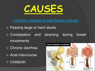Anal fissures | PPTX