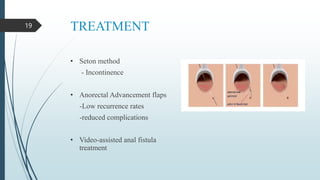 ANAL FISTULA a surgical dissection including treatment | PPTX