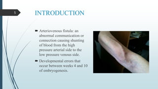 ANAL FISTULA a surgical dissection including treatment | PPTX