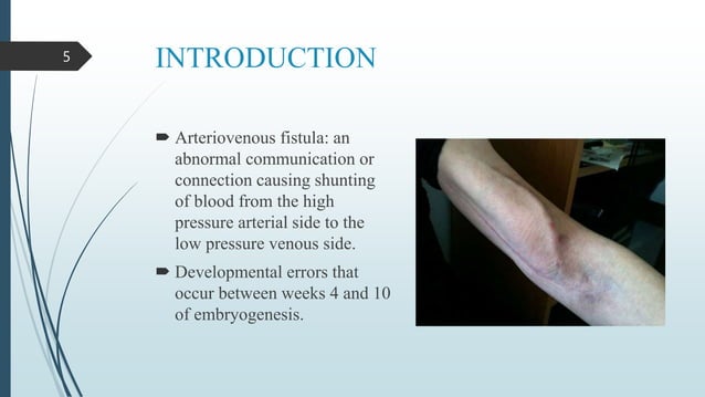 ANAL FISTULA a surgical dissection including treatment | PPTX