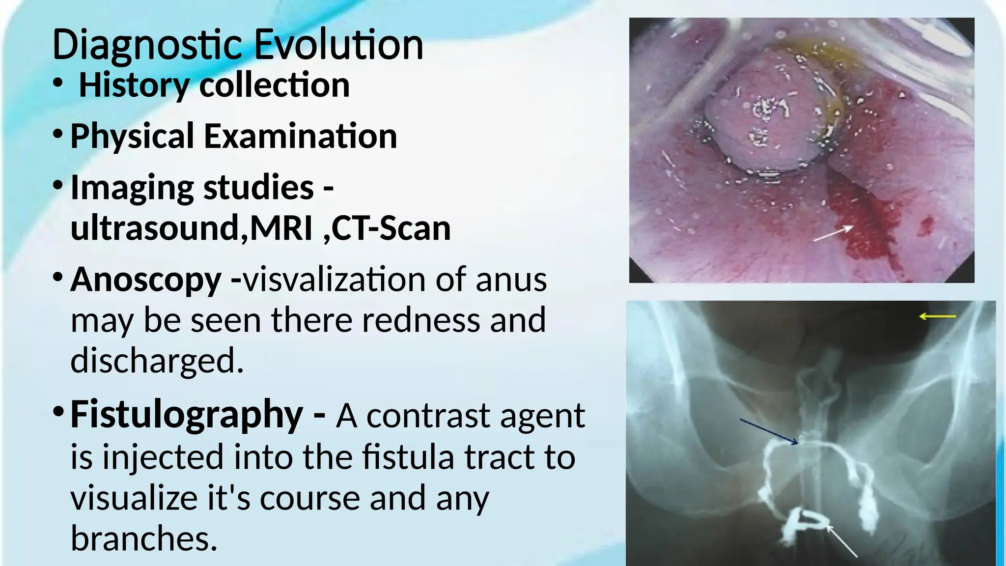 anal fistula .pptx (1).pptx. what is anal fistula underlying the ...