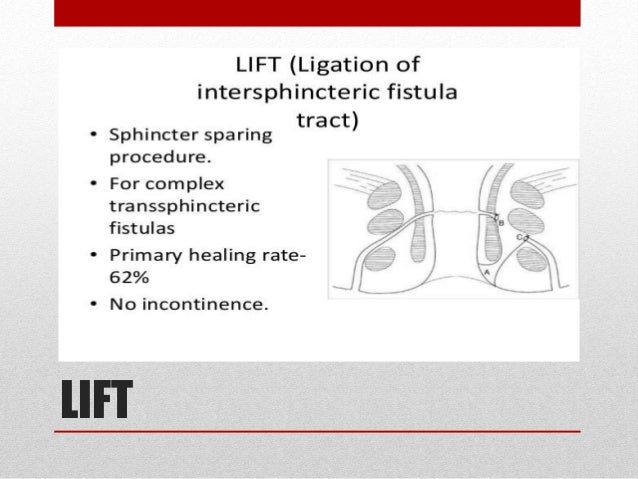 Anal fistula presentation - dr. islam alatiar MRCS
