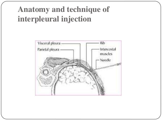 Analgesia in thoracic surgery.