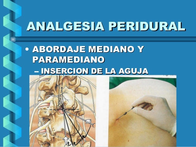 Analgesia peridural