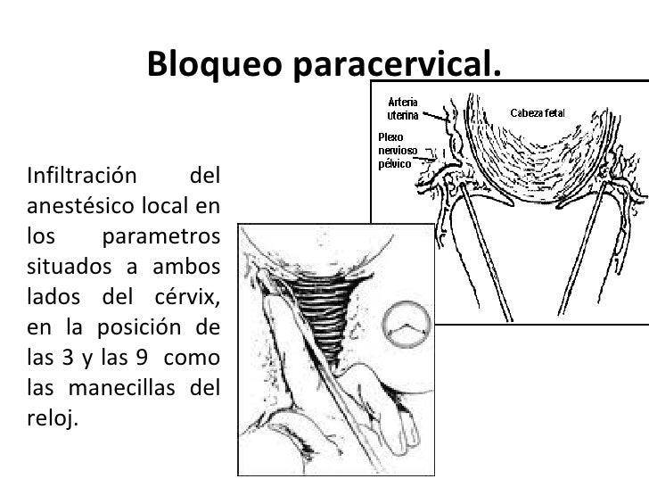 Analgesia y anestesia en obstetricia