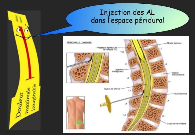 Analgésie locorégionale continue périnerveuse et péridurale
