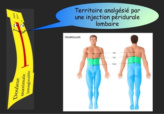 Analgésie locorégionale continue périnerveuse et péridurale